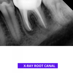 Root Canal Treatment In Noida – Best Dental Clinic In Noida | Top ...